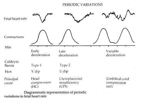 Non Reassuring Fetal Heart Rate