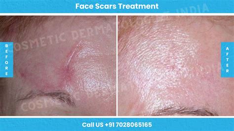 Face Scars Treatment Mumbai Acne Scars Treatment Cost In India