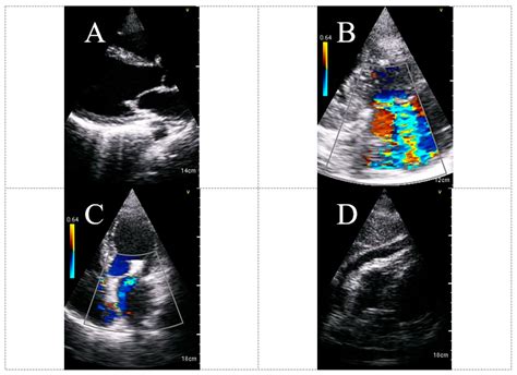 Abnormal Echocardiogram