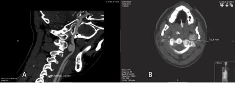 Treatment Of Aneurysms Of The Extracranial Carotid Artery Current