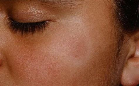 علت لکه‌های سفید روی پوست کودکان و روش‌های درمان آن همشهری آنلاین