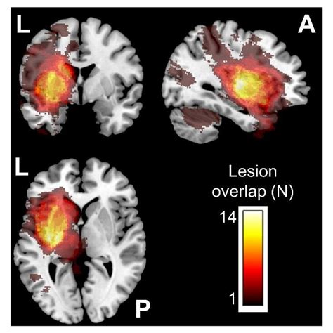 lesion heatmap of patients at the acute or subacute if data