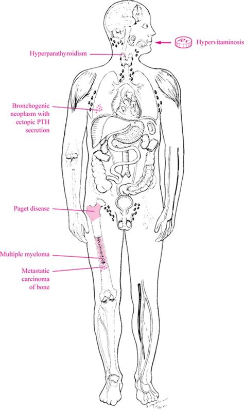 Hypercalcemia Differential Diagnosis In Primary Care 4th Edition