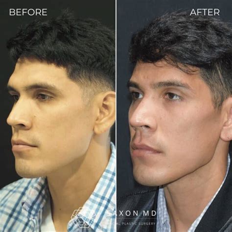 Can Men Get A Brow Bone Reduction Prominent Brow Ridge