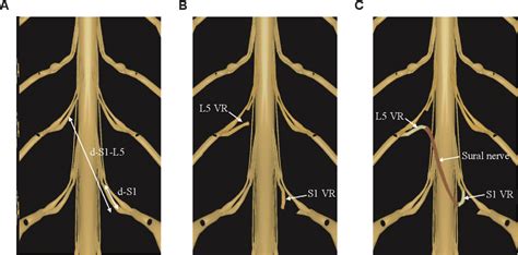 Figure 1 From Extradural Contralateral S1 Nerve Root Transfer For Spastic Lower Limb Paralysis