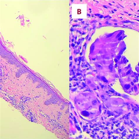 Duodenal Bulb Polyp Histologically Consistent With Benign