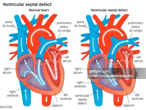 Comparison Of A Normal Heart To One With A Ventricular Septal Defect