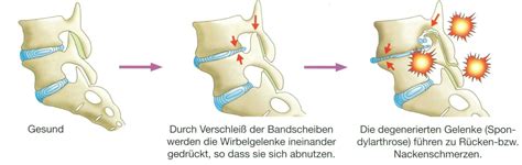 Spondylarthrose Behandlungstherapie Xifkkc
