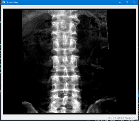 qt5使用qgrahicsview显示dicom图像 qt dicom csdn博客
