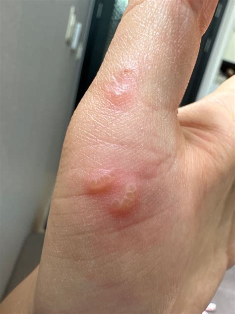 손에 수포 한포진 헤르페스 강아지 알레르기 지식in