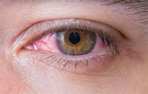 Stringy Eye Discharge