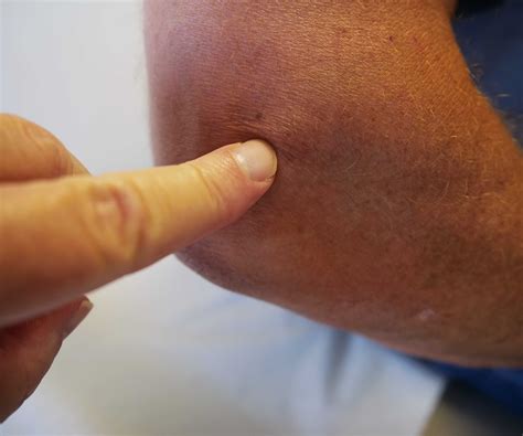 Lateral Epicondylitis Test