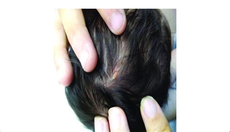 Lesion On The Scalp Located Near The Sagittal Suture Comprised Of Download Scientific Diagram