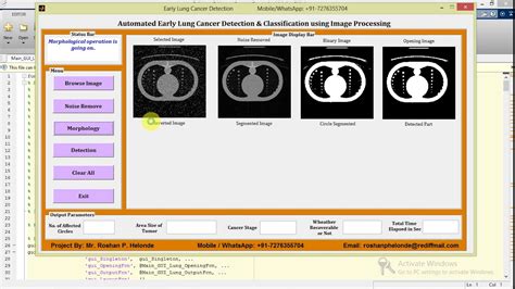 Lung Cancer Detection And Classification Using Image Processing Matlab