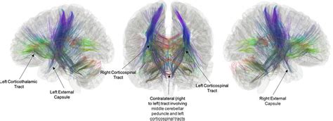 Language Performance Within Ept Whole Brain Whole Brain Connectometry