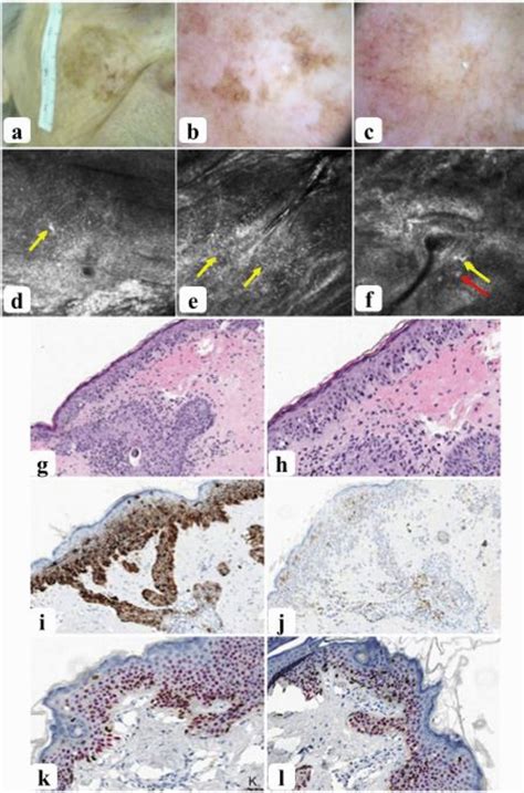 A Clinical Image Of The Brownish Macula In The Right Malar Region B C Download Scientific