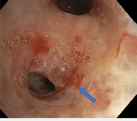 Bronchoscope Imaging Showing Narrowing Of The Segmental Bronchus And Download Scientific