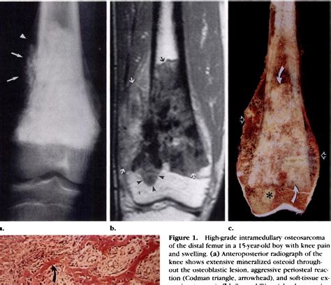 Osteogenic Sarcoma Codmans Triangle Osteogenic Sarcoma Codmans Triangle