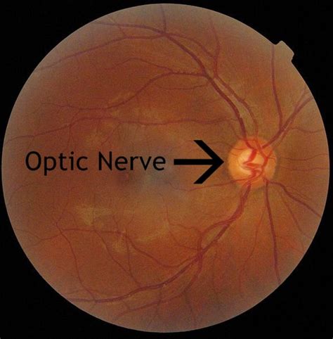 Glaucoma Eye Biology Nerve Damage And Recent Research Owlcation