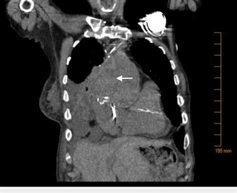 Arrow Showing Large Peri Aortic Hematoma Formation In The Setting Of