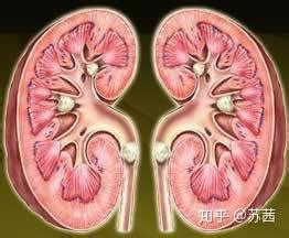 肾结石掉到膀胱里排出去的时候会疼吗