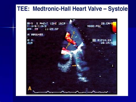 Prosthetic Heart Valves Ppt