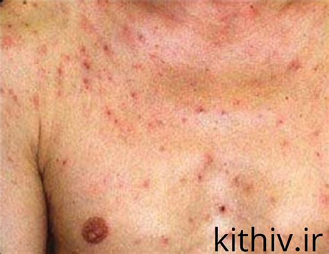 زخم‌ های ایدز علائم پوستی که نباید نادیده بگیرید کیت Hiv