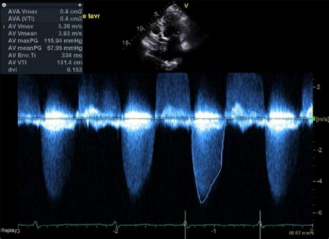 Continuous Wave Doppler Aortic Valve