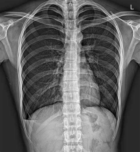 흉부 엑스레이 창의적인 활동 유치원 아이디어 유아 놀이