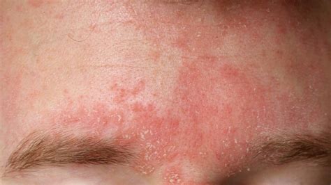 Seborrheic Eczema Face