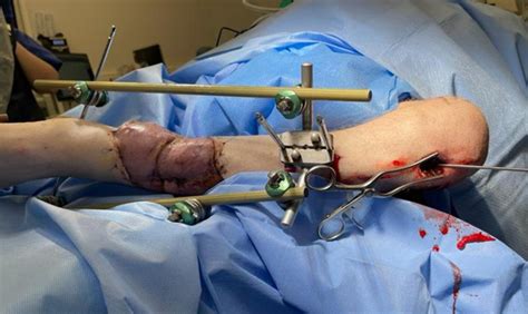 This Patient Suffered An Open Fracture Of The Lower Tibia Initially Download Scientific