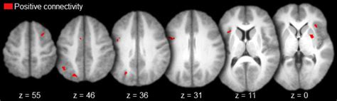 Mediodorsal Thalamus Functional Connectivity Results Axial Slices Key Download Scientific