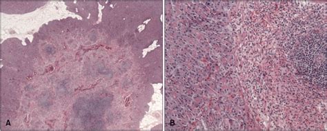 Ectopic Splenic Tissue In The Pancreas Of Clone 1 A The Figure Shows Download Scientific