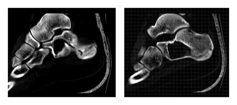 Ct Scan Views On The Sagittal Plane Showing An Undisplaced Pathologic