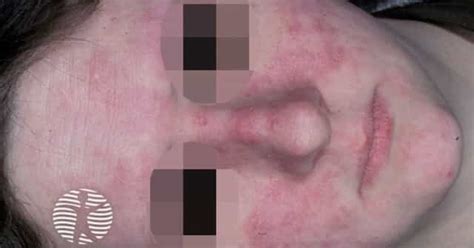 Subacute Lupus Erythematosus Image