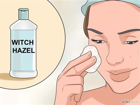 Ways To Reduce The Swelling And Redness Of Pimples WikiHow Espinillas Remedios Para Las
