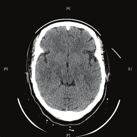 A Plain Cranial Ct Scan Showing Multiple Hypodense Lesions In The