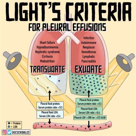 Nte®️n🅰️l Ⓜ️edℹ©️ℹne On Twitter Rt Paul Wischmeyer 💡lights Criteria For Pleural Effusions