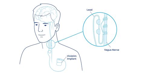 Stroke Patients Increase Upper Limb Function Using Breakthrough Treatment