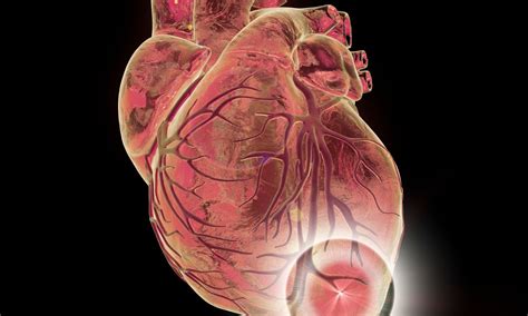 Ecmo Linked With Increased Bleeding Risk Among Patients With