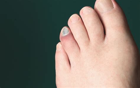 Stubbed Toe Treatment When Do You Need To Seek Help