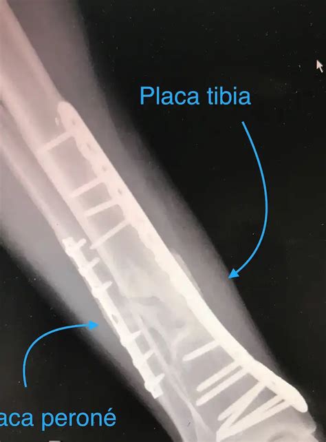 Pseudoartrosis De Tibia Utcvitoria
