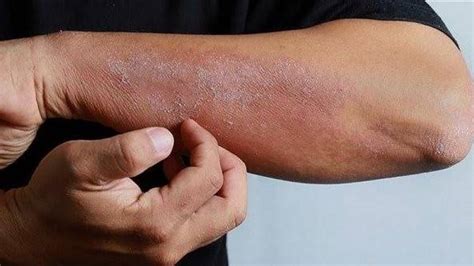 الأنواع المختلفة لعدوى الفطريات الجلدية، وطرق علاجها