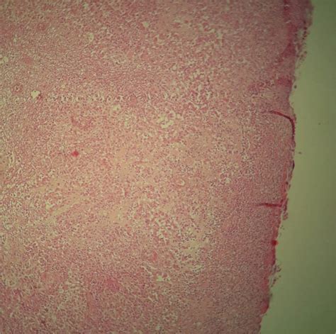 Unusual Penile Localization Of Melanoma Pmc