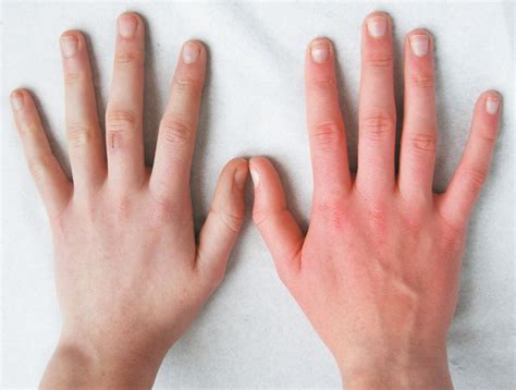 An Overview Of Erythromelalgia Artofit