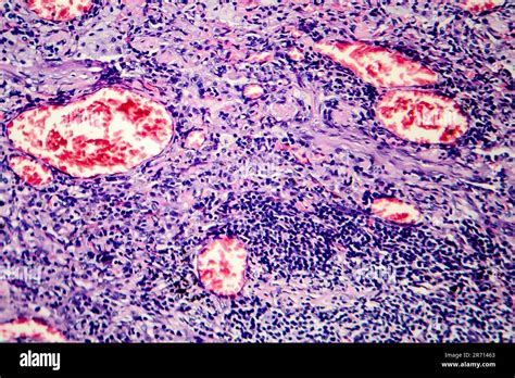 Histopathology Of Tuberculosis Light Micrograph Of Tuberculosis Lesion Photo Under Microscope