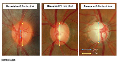 Eye Anatomy — Ophthobasics