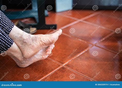 Close Up Of Bare Feet Of An Adult Person With Various Health Problems Stock Photo Image Of