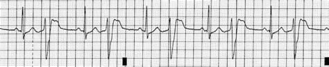 Troubling Tachycardia LITFL Clinical Cases ECG Exigency