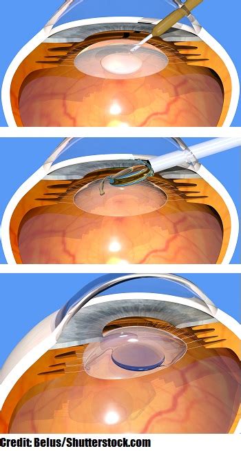 Cataracts Nclex Nursing Review Eye Disorders